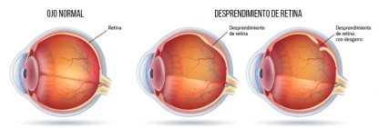 ¿Qué es el desprendimiento de retina? - Comercializadora Lux, S.A. de C.V.