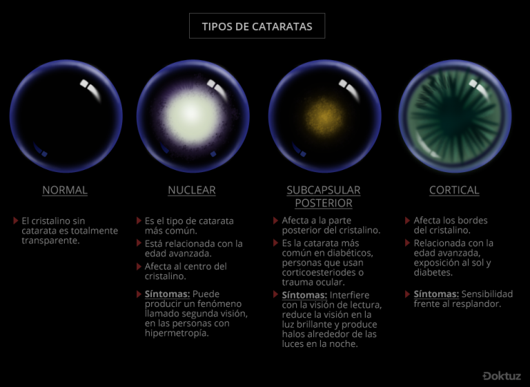 Tipos de cataratas - Comercializadora Lux, S.A. de C.V.
